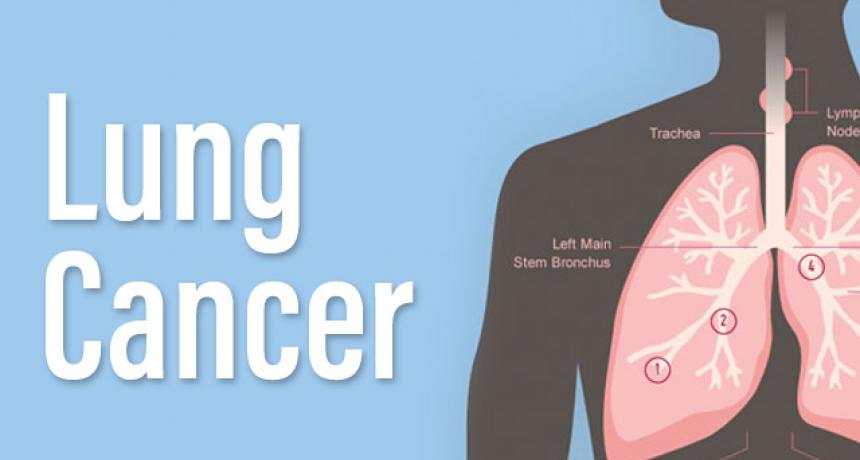 Lung Cancer: A Visual Guide